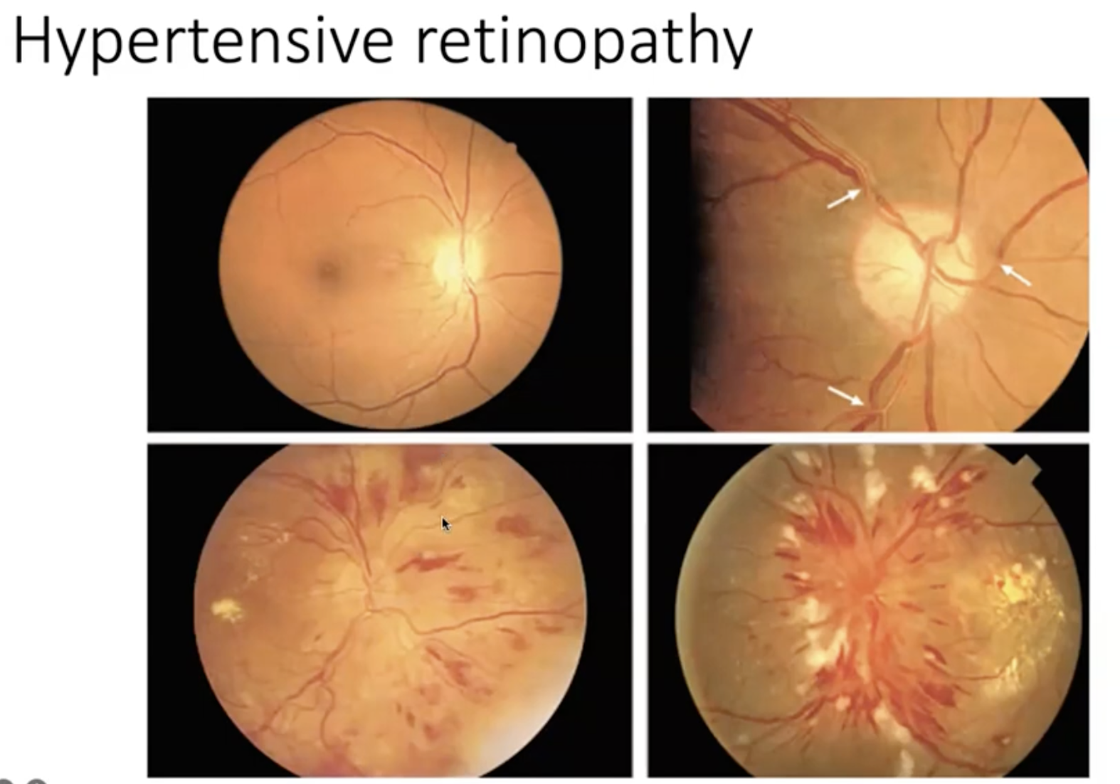 Hypertensive Retinopathy Vs Normal